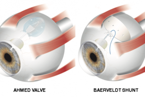 What Is a Tube Shunt Drainage Implant for Glaucoma?