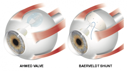 What Is a Tube Shunt Drainage Implant for Glaucoma?